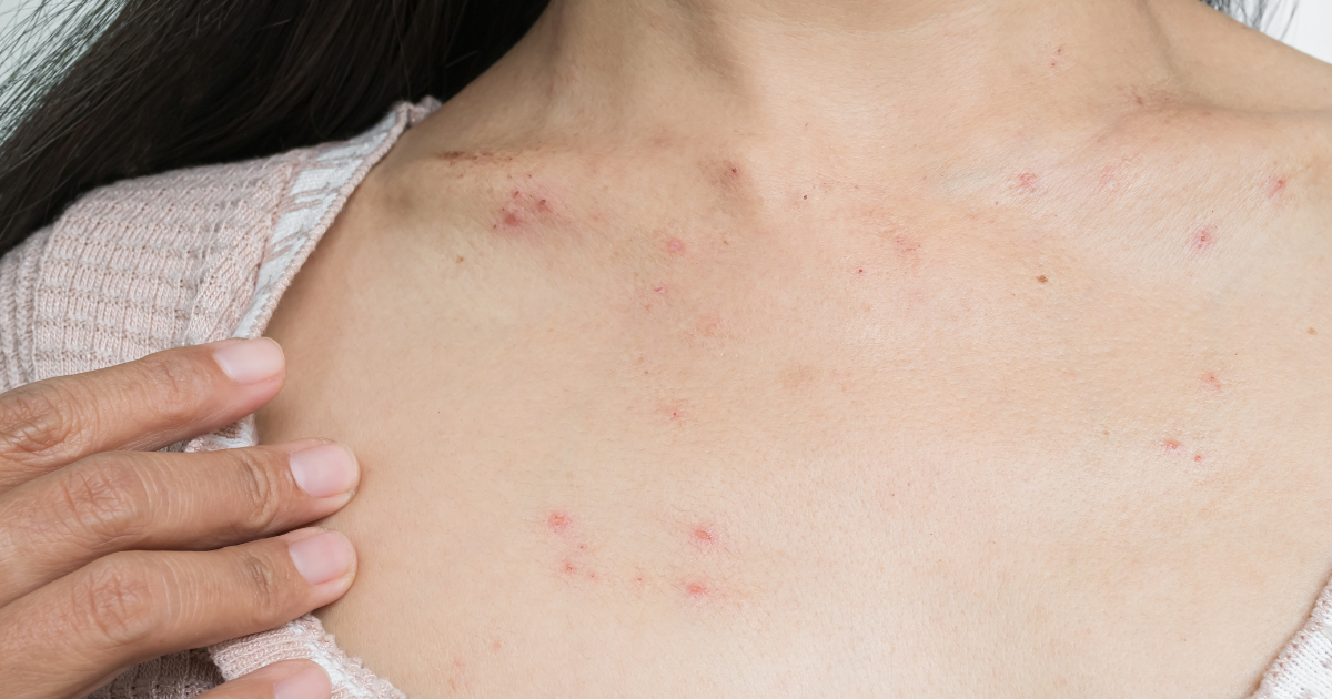 Anxiety Rash: Causes, Symptoms, and Calming Skin Care Tips - California ...